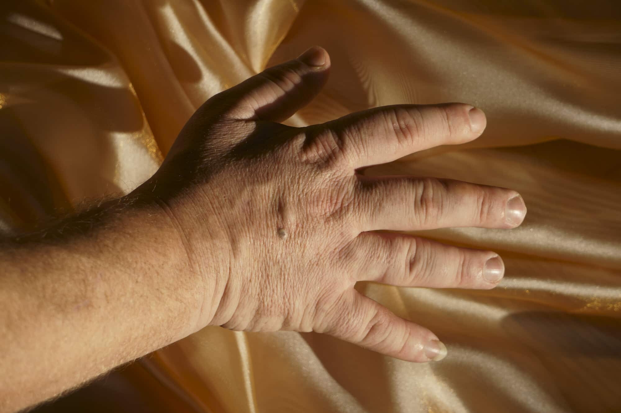 Acromegaly Treatment in Turkey | Endocrinology in Turkey