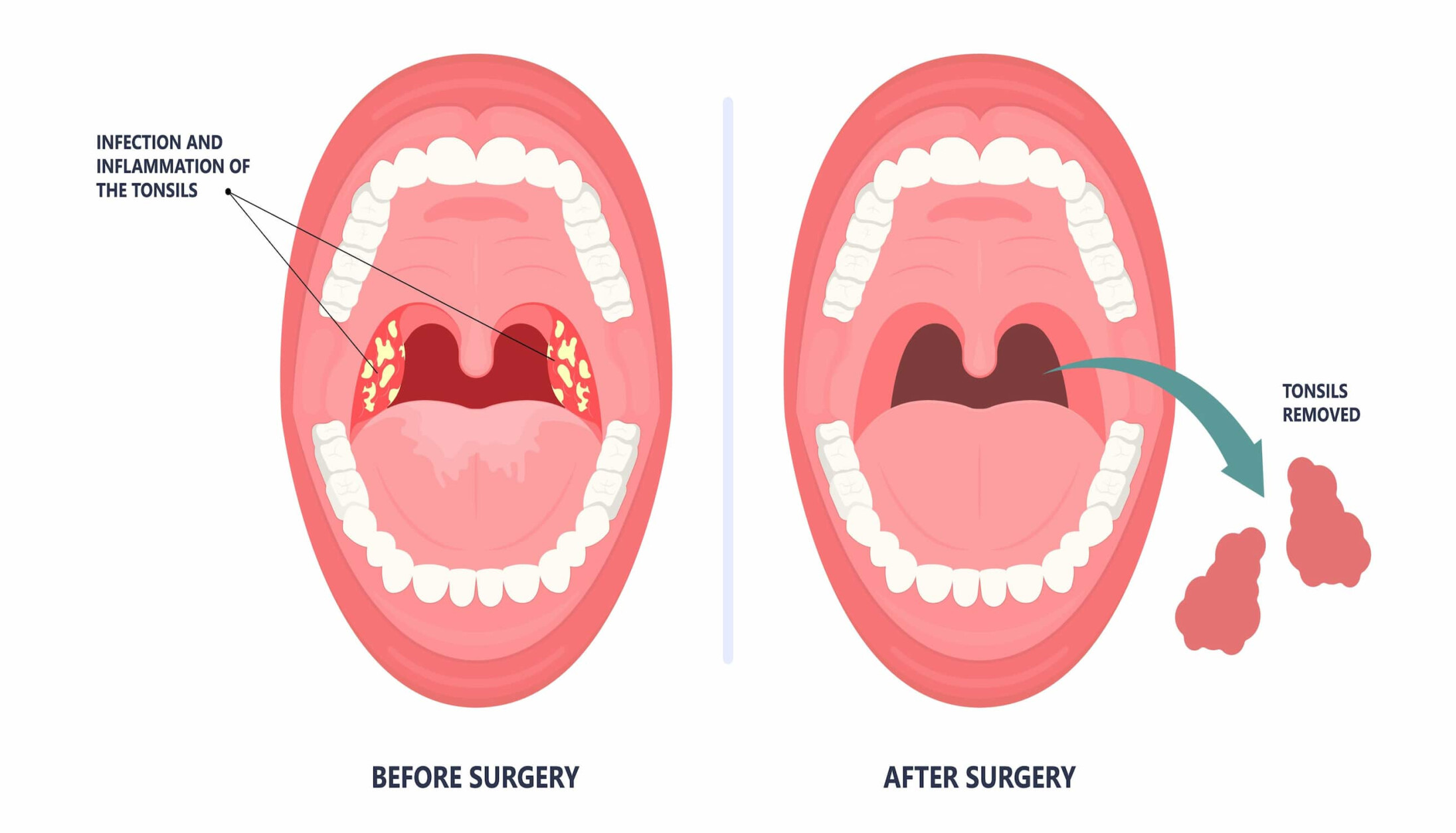 Amigdalectomía en Turquía | Beneficios y Costos 2026