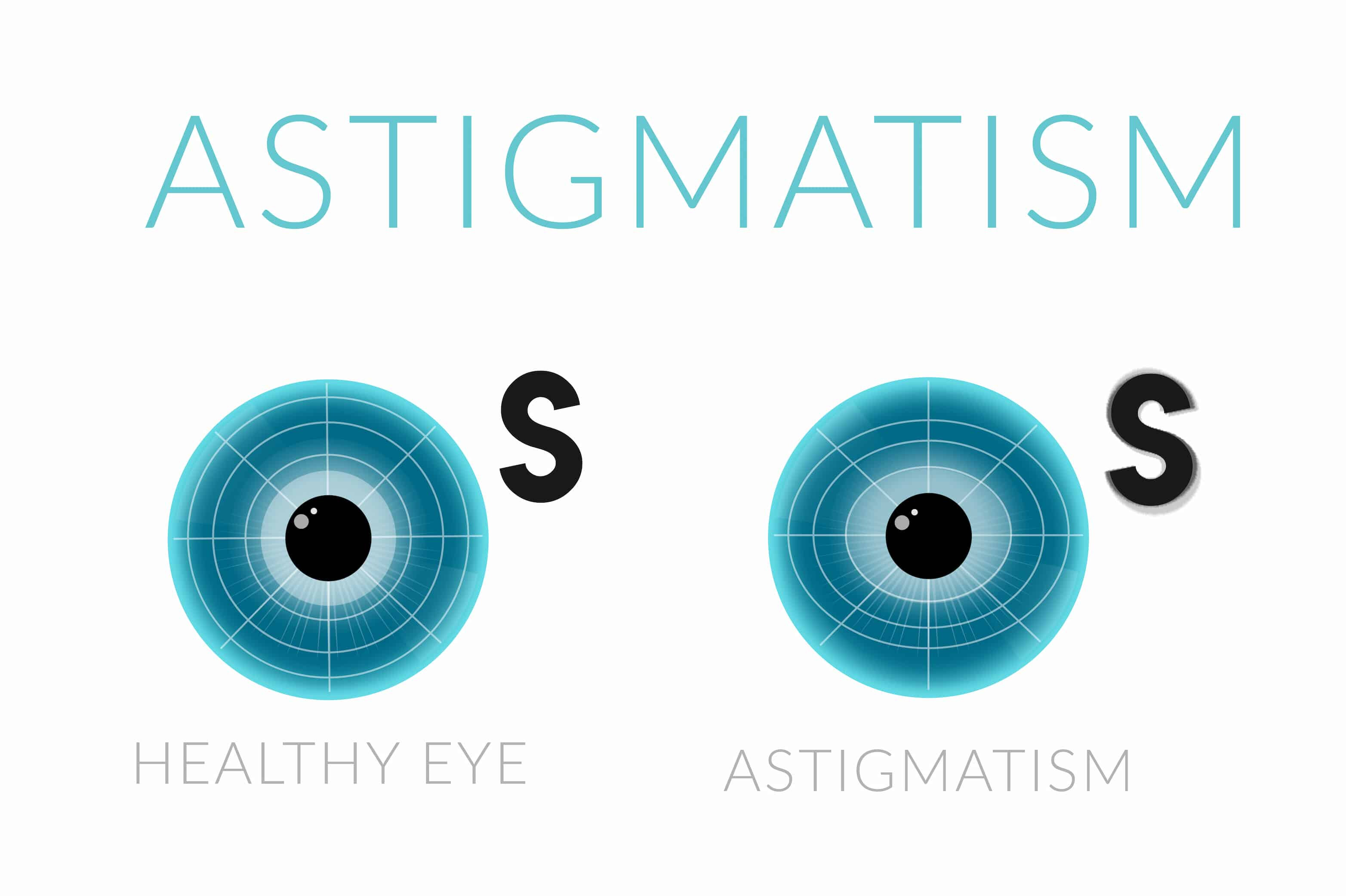 Astigmatism Treatment in Turkey | Free Online Consultation