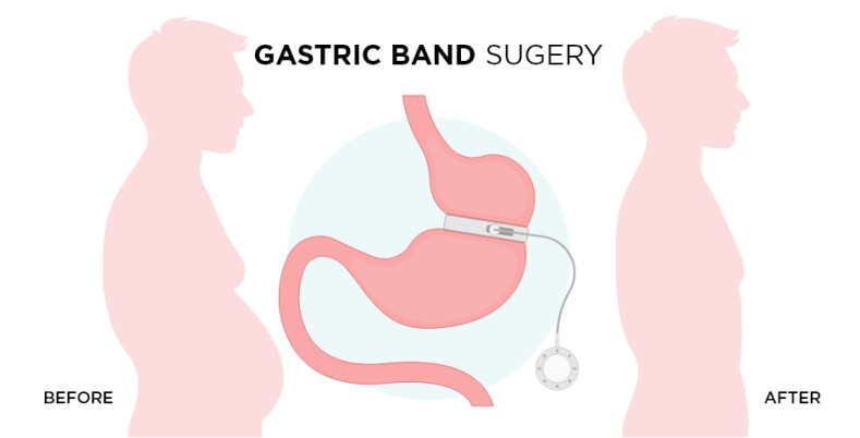 Benefits of Lap Band | Weight Loss Surgery | Healty Turkiye