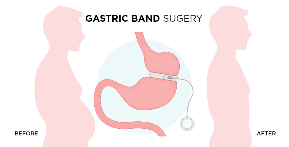 Benefits of Lap Band | Weight Loss Surgery | Healty Turkiye