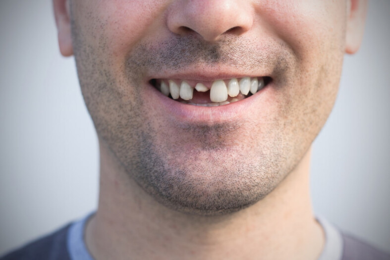 Broken Tooth, But No Pain? Here’s What To Do About It