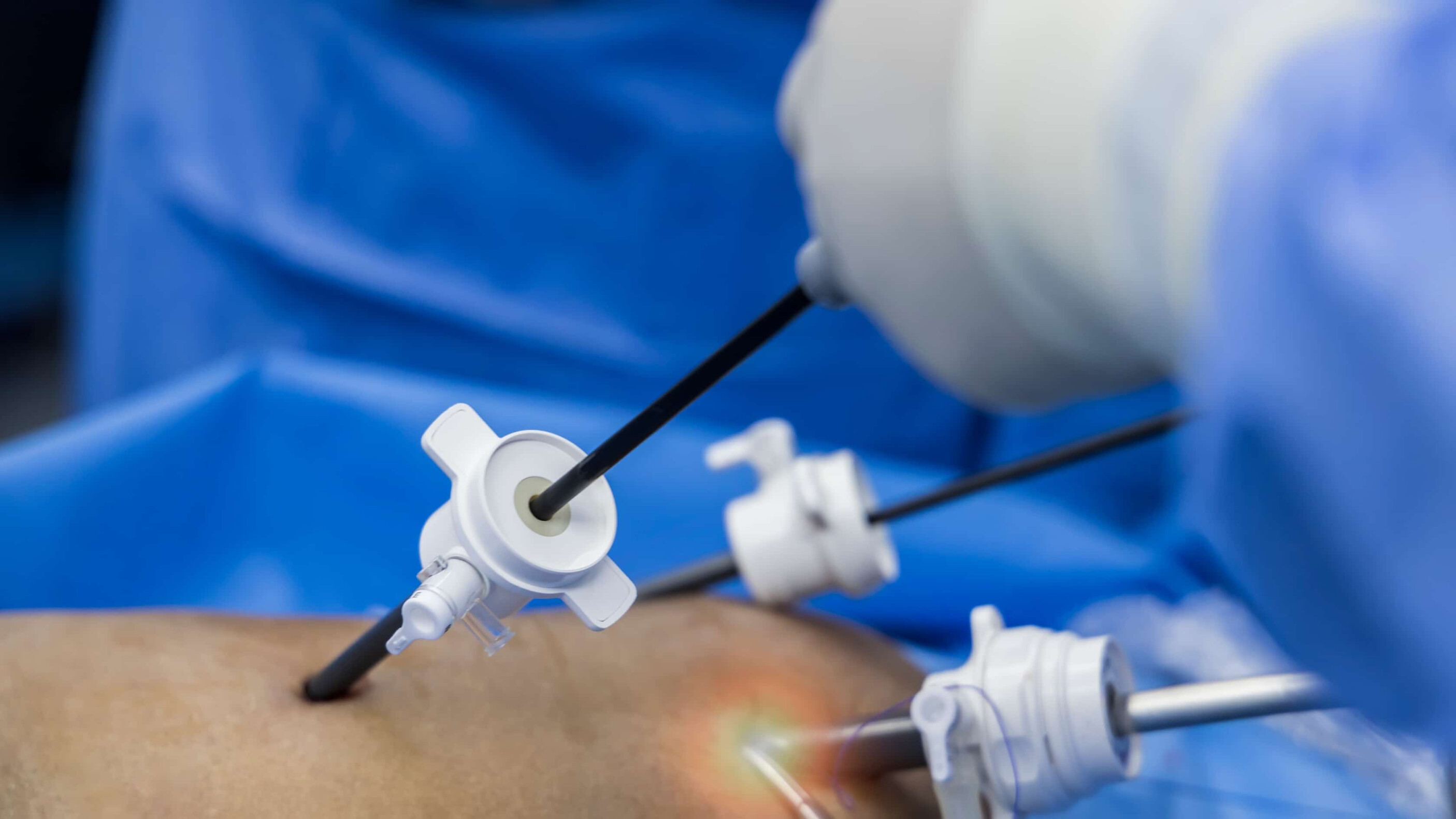 Colecistectomie Laparoscopică în Turcia | Colecistectomie