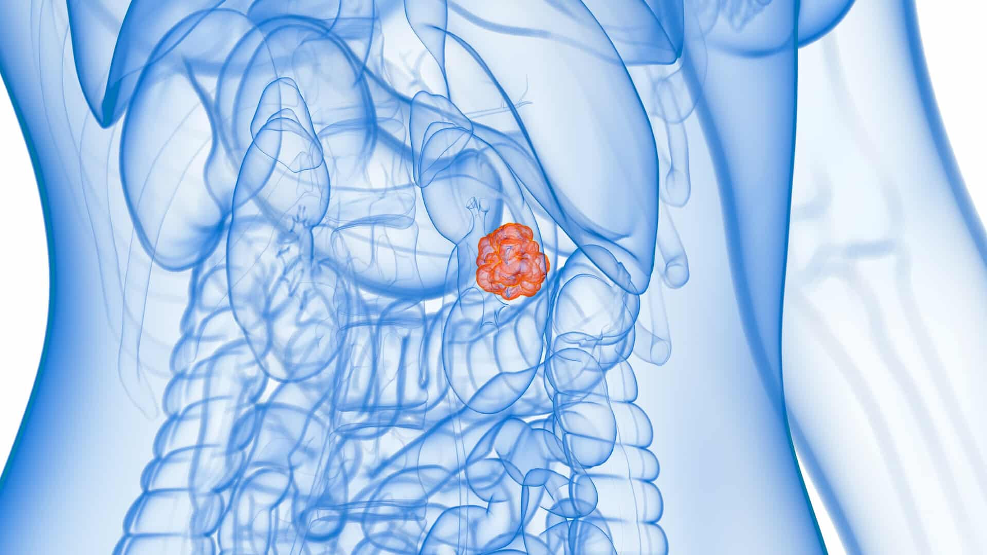Cystic Kidney Diseases Treatment in Turkey | 2026 Costs