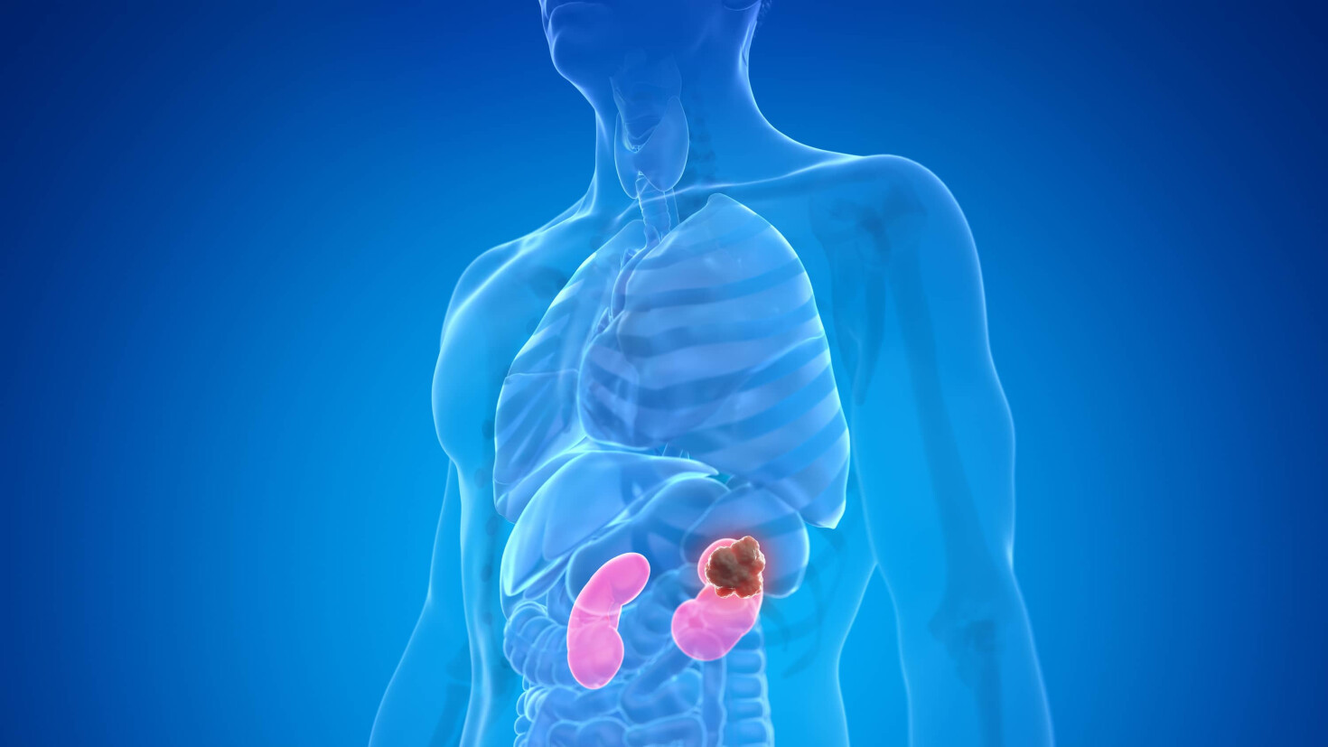 Cystic Kidney Diseases Treatment in Turkey | 2026 Costs