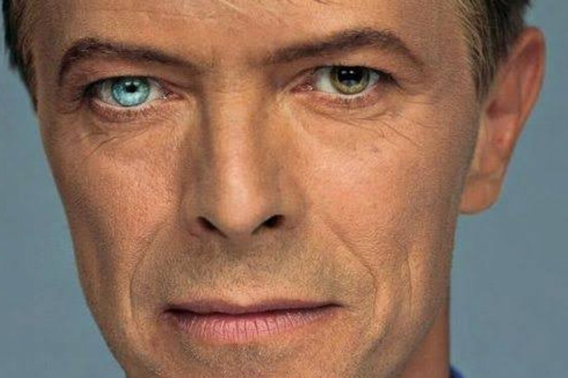 David Bowie's Different Colored Eyes | Healthy Türkiye