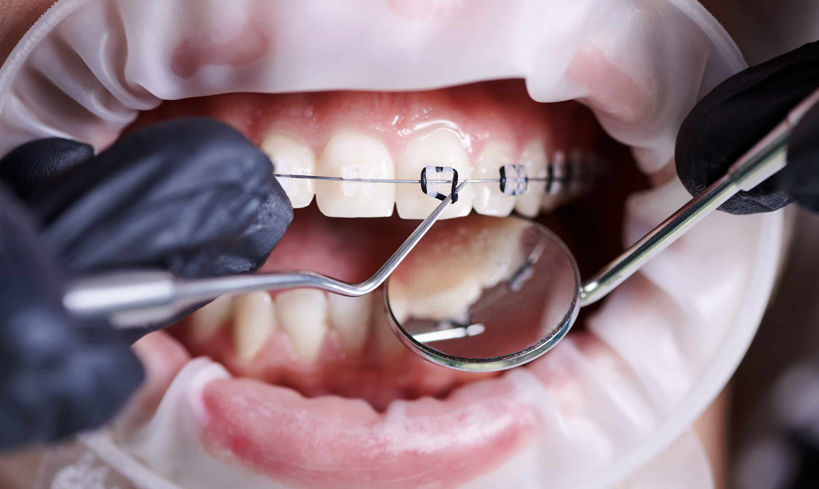 Dental Braces Treatment in Turkey | Orthodontic Treatment