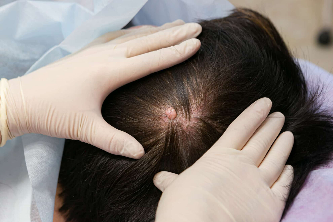 Dermatofibromas Removal in Turkey | Free Online Consultation