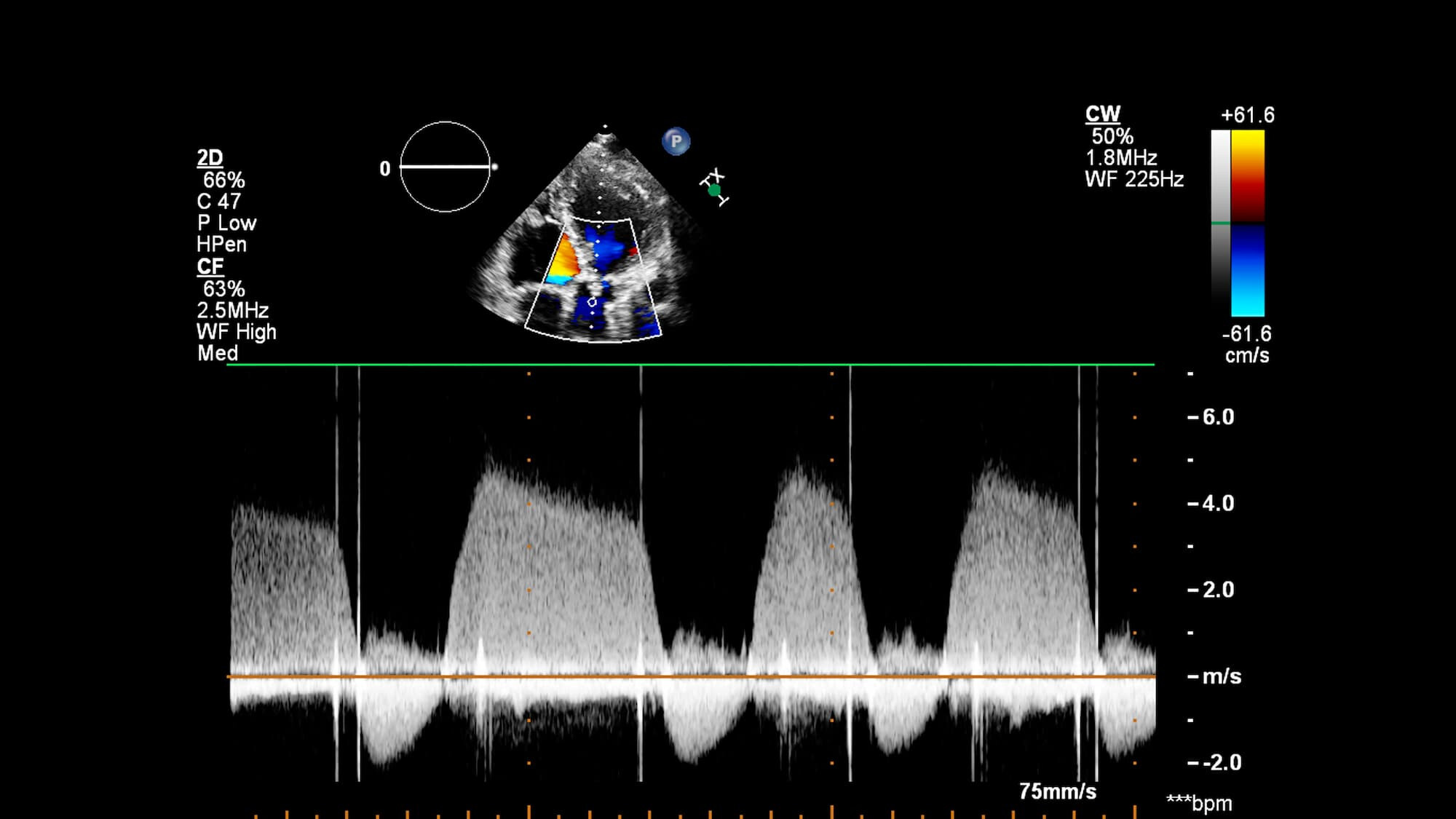 Difference Between Doppler and Duplex: Medical Imaging