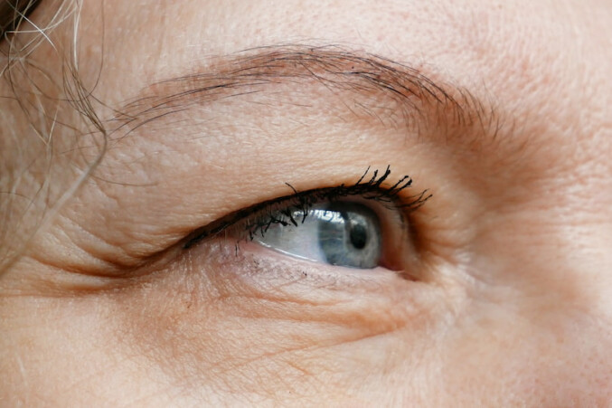 Eyelid Surgery in Turkey | Blepharoplasty Prices 2026