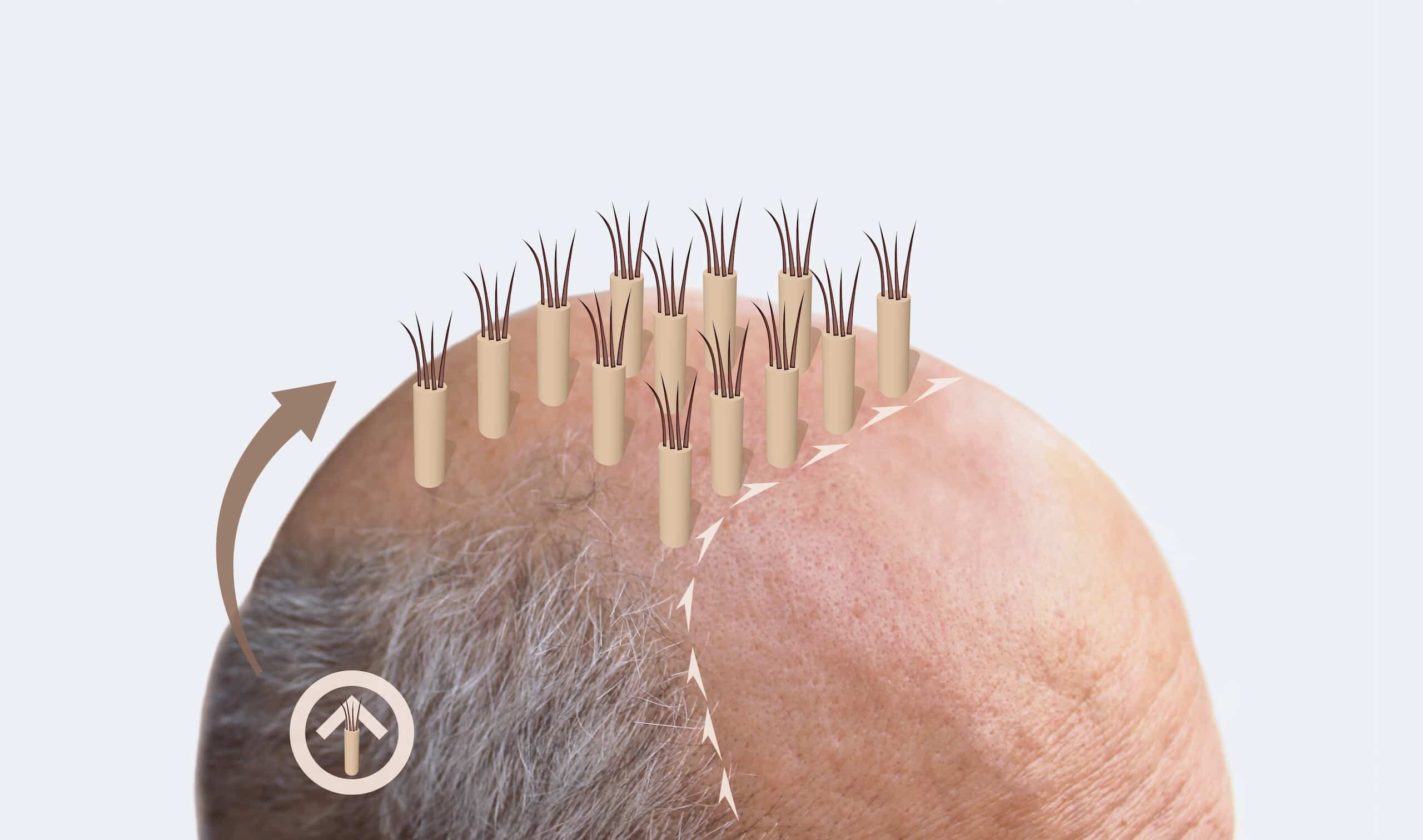 FUT Hair Transplant | Hair Transplant in Turkey
