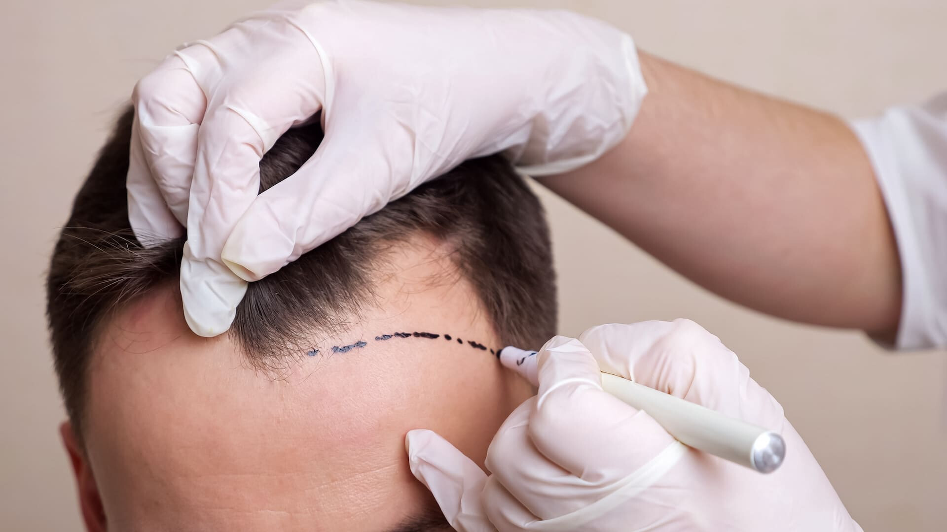 Hair Transplant in Turkey | Hair Transplant 2026 Costs
