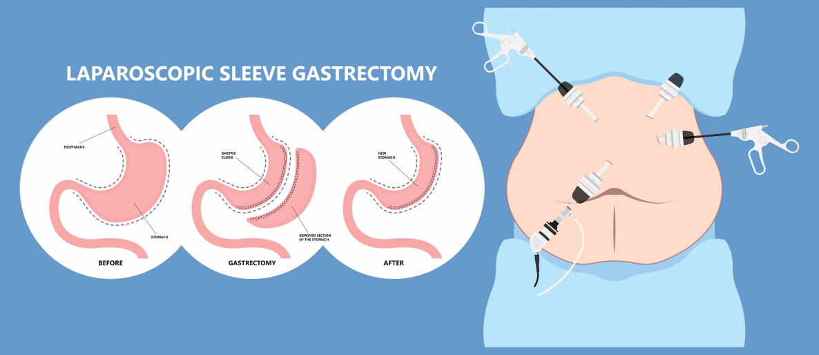 Laparoscopic Sleeve Gastrectomy in Turkey | Gastric Sleeve