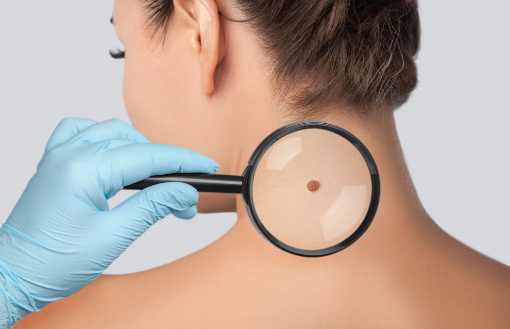Mole Removal Surgery in Turkey | Check 2026 Cost & Prices