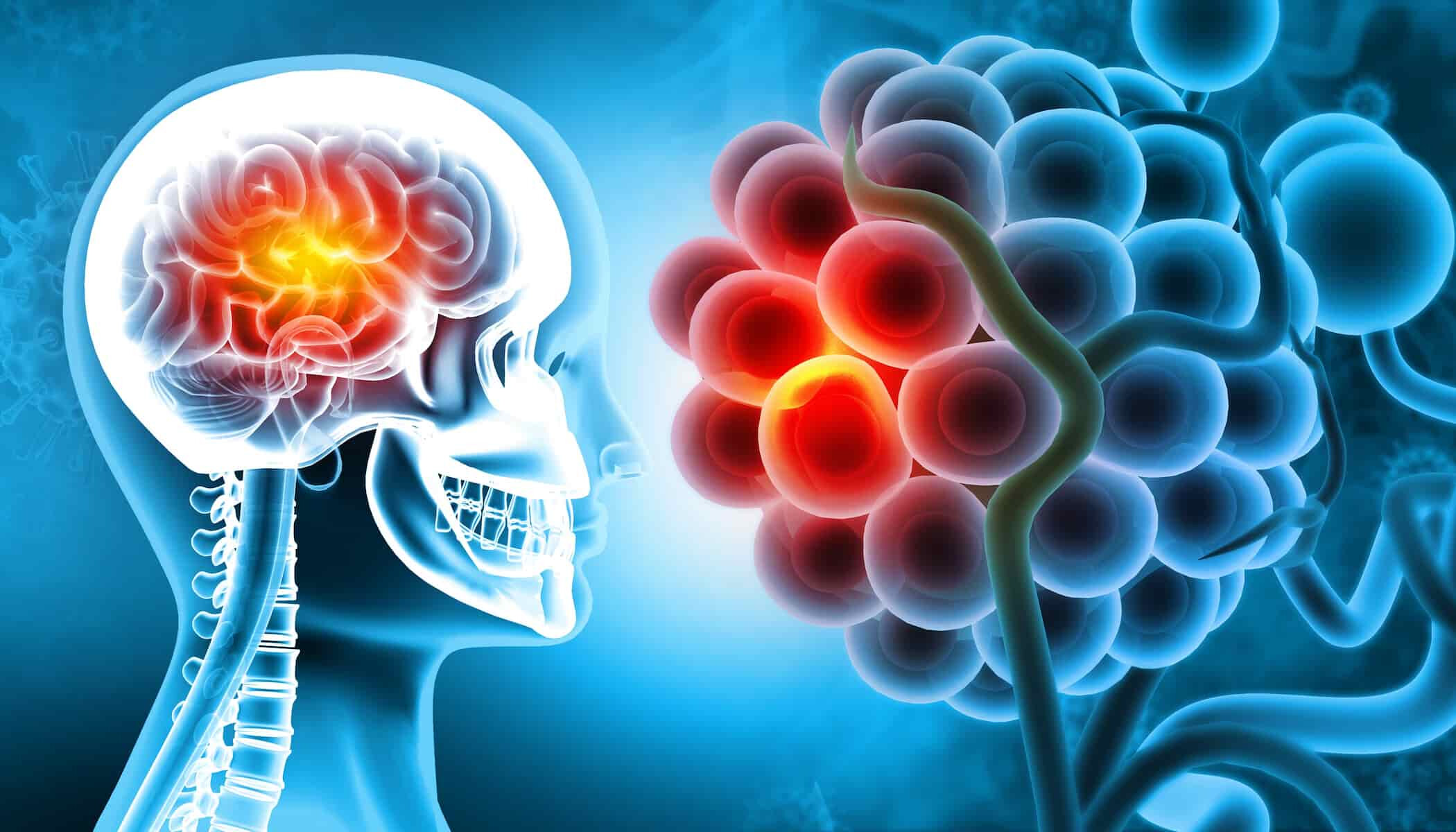 Neurotrauma Treatment in Turkey | Neurosurgery in Turkey