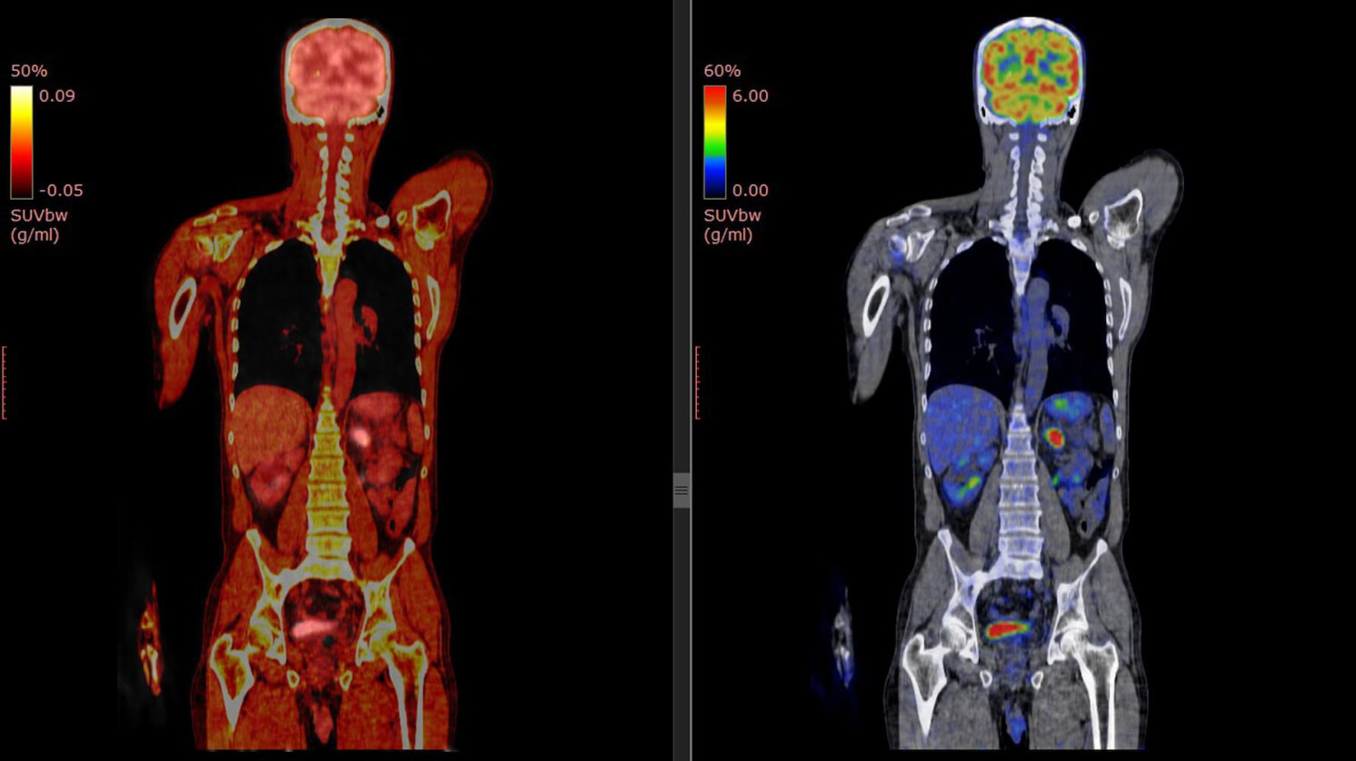 PET Scan in Turkey | Check PET Scan 2026 Costs & Prices