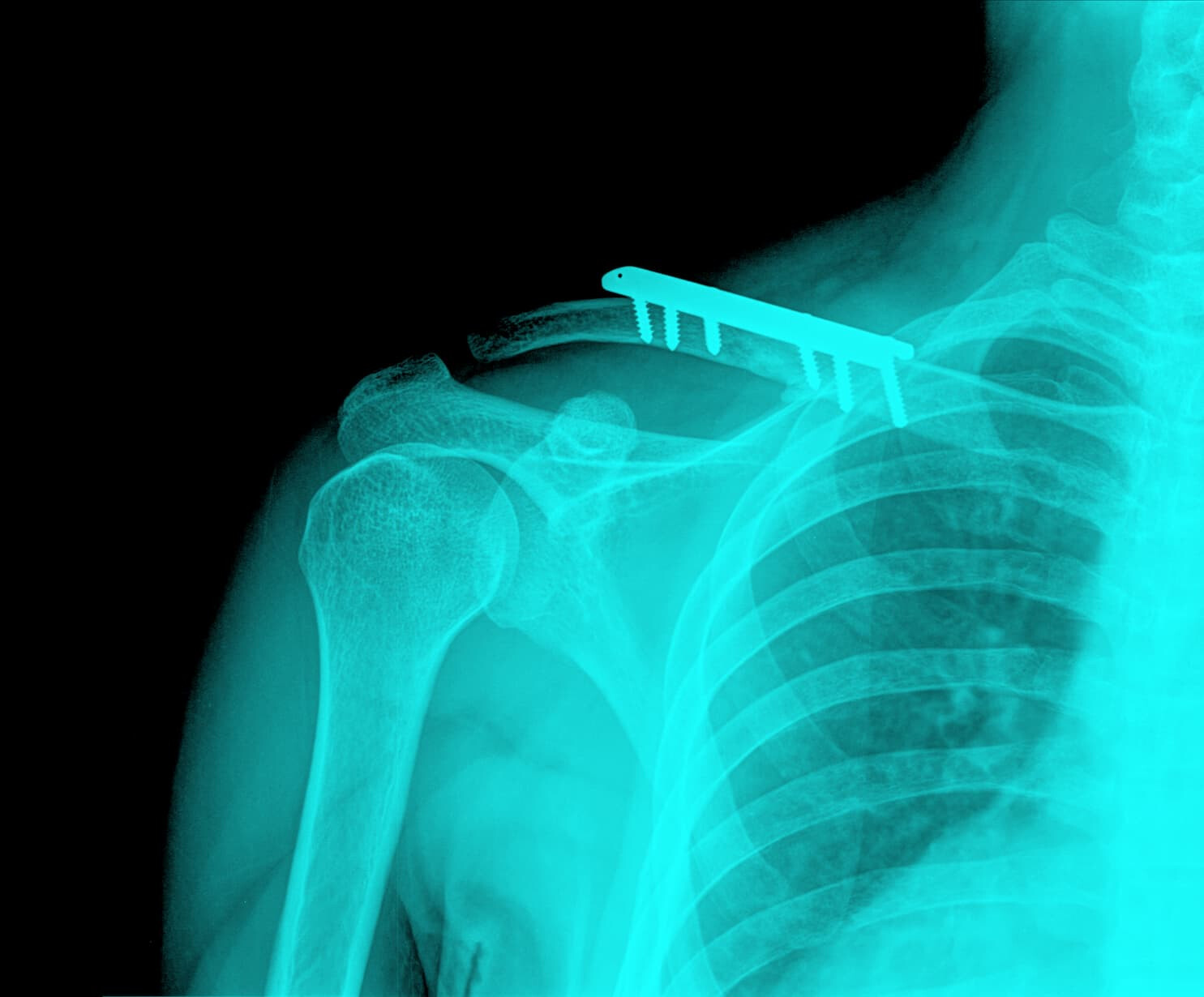 Shoulder Replacement Surgery in Turkey | 2025 Prices & Cost