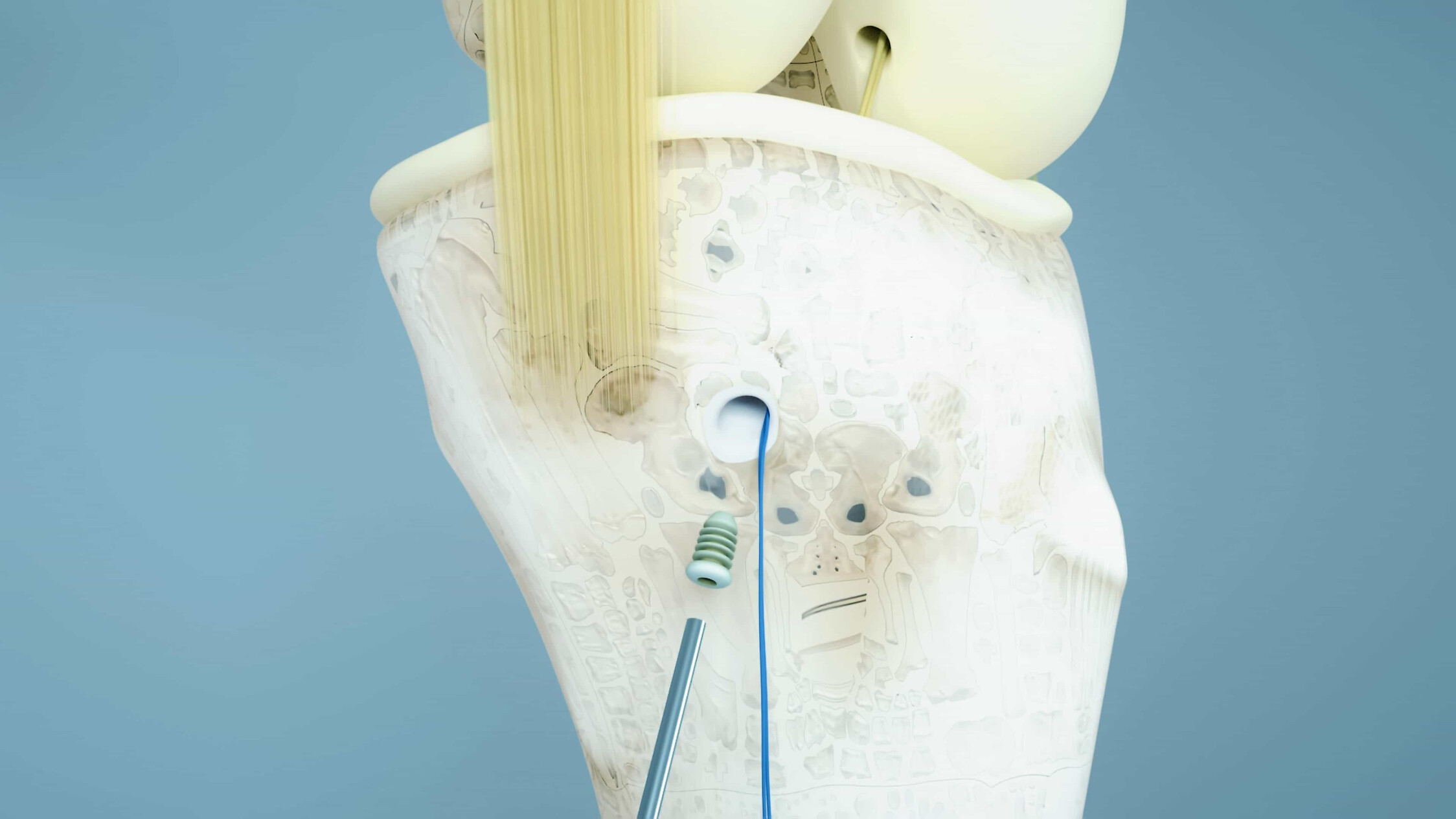 Torn Meniscus Treatment in Turkey | Meniscus Tear Treatment