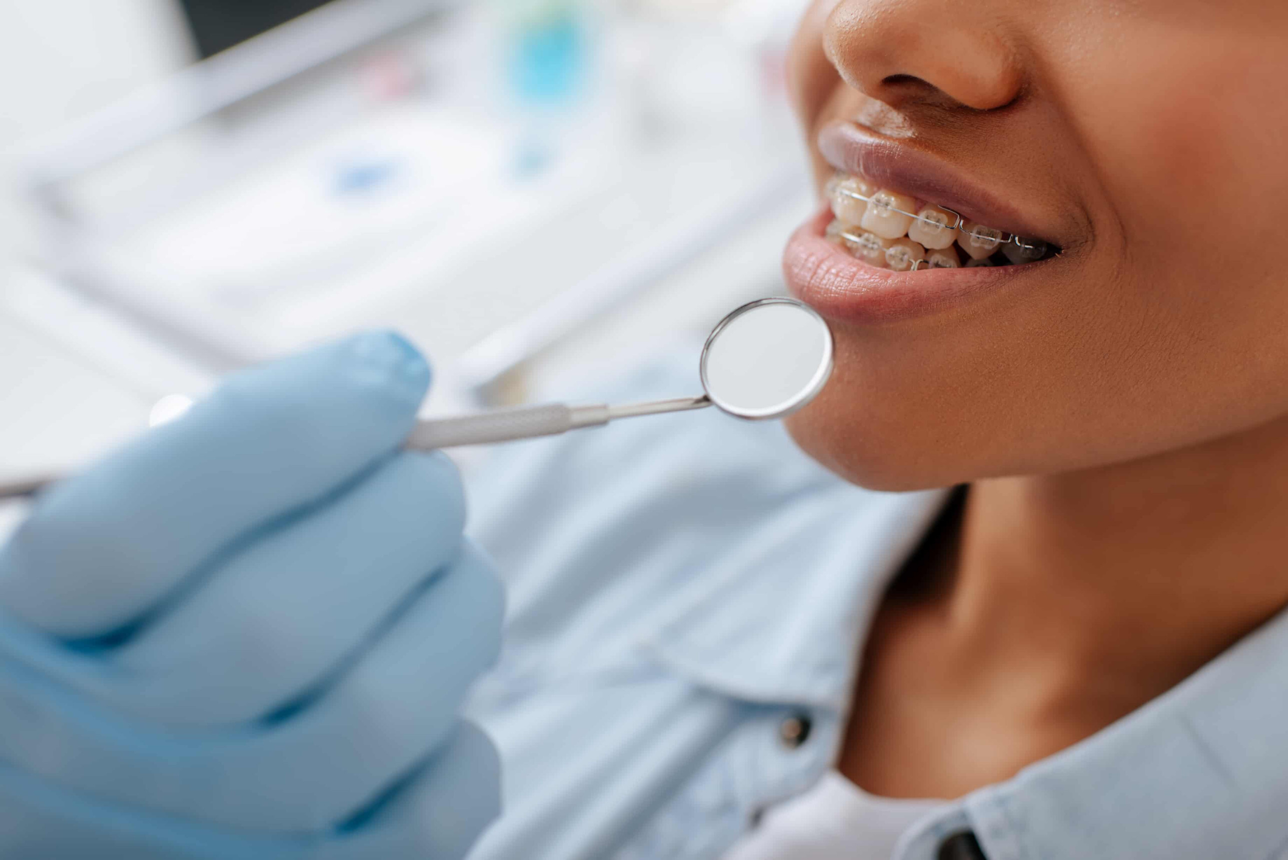 Dental Braces Treatment in Turkey | Orthodontic Treatment