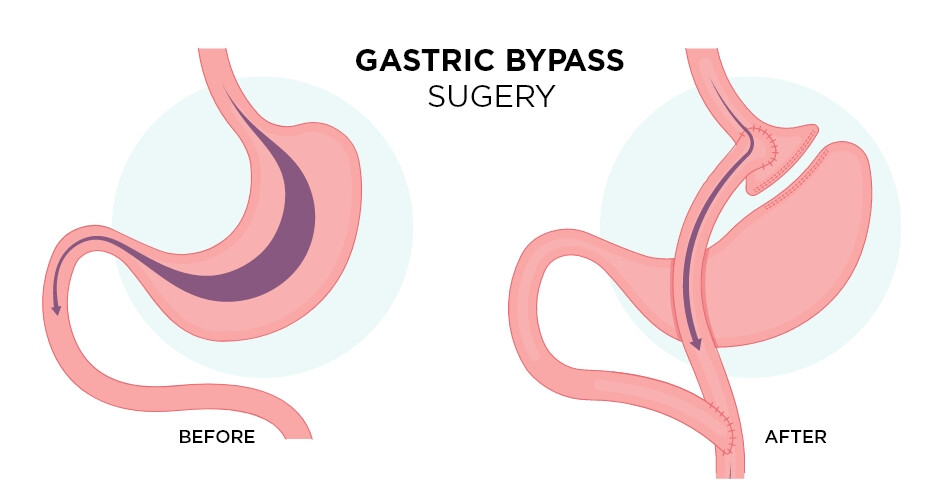 Gastric Bypass Surgery in Turkey | Check 2025 Cost & Prices