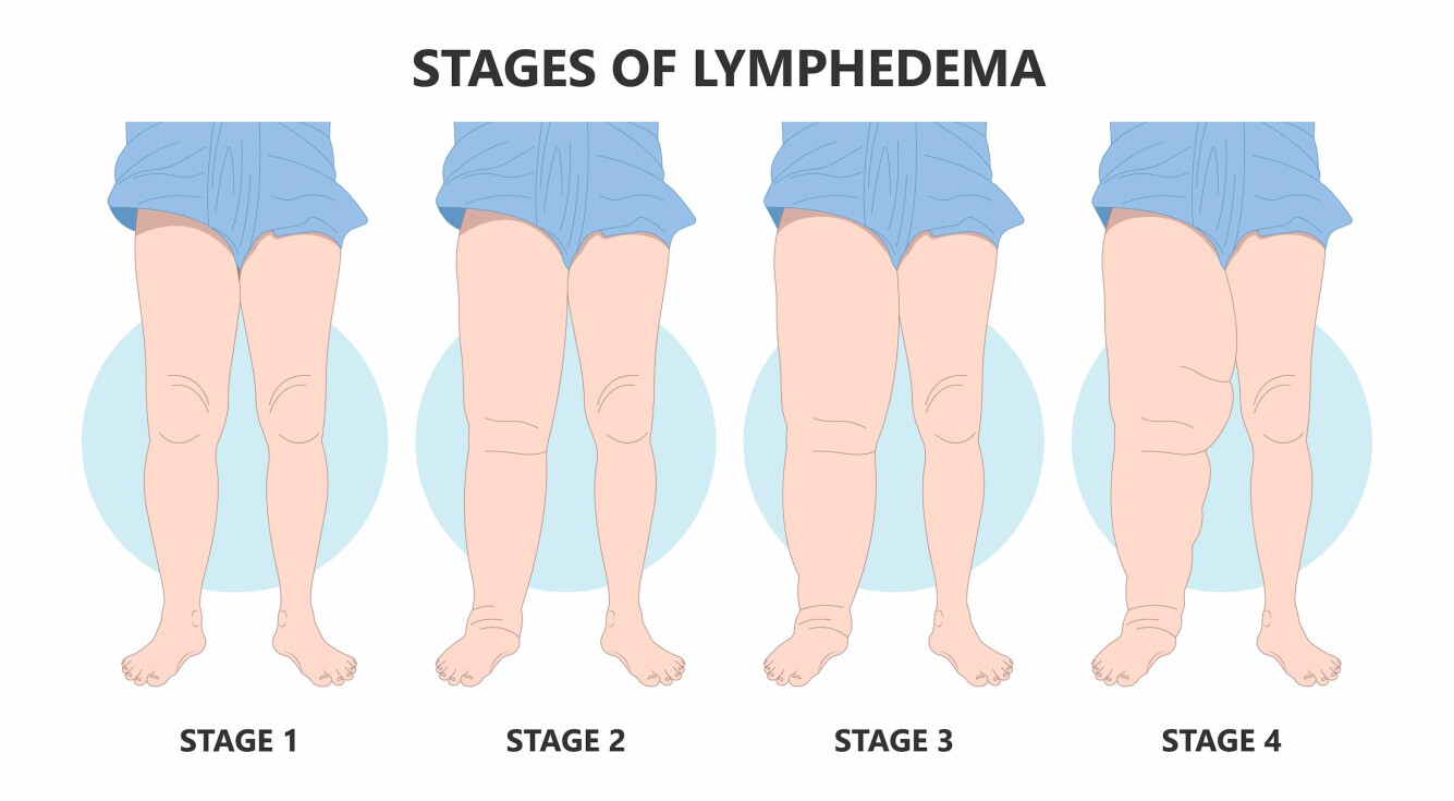 Lymphoedema Treatment in Turkey | Free Online Consultation