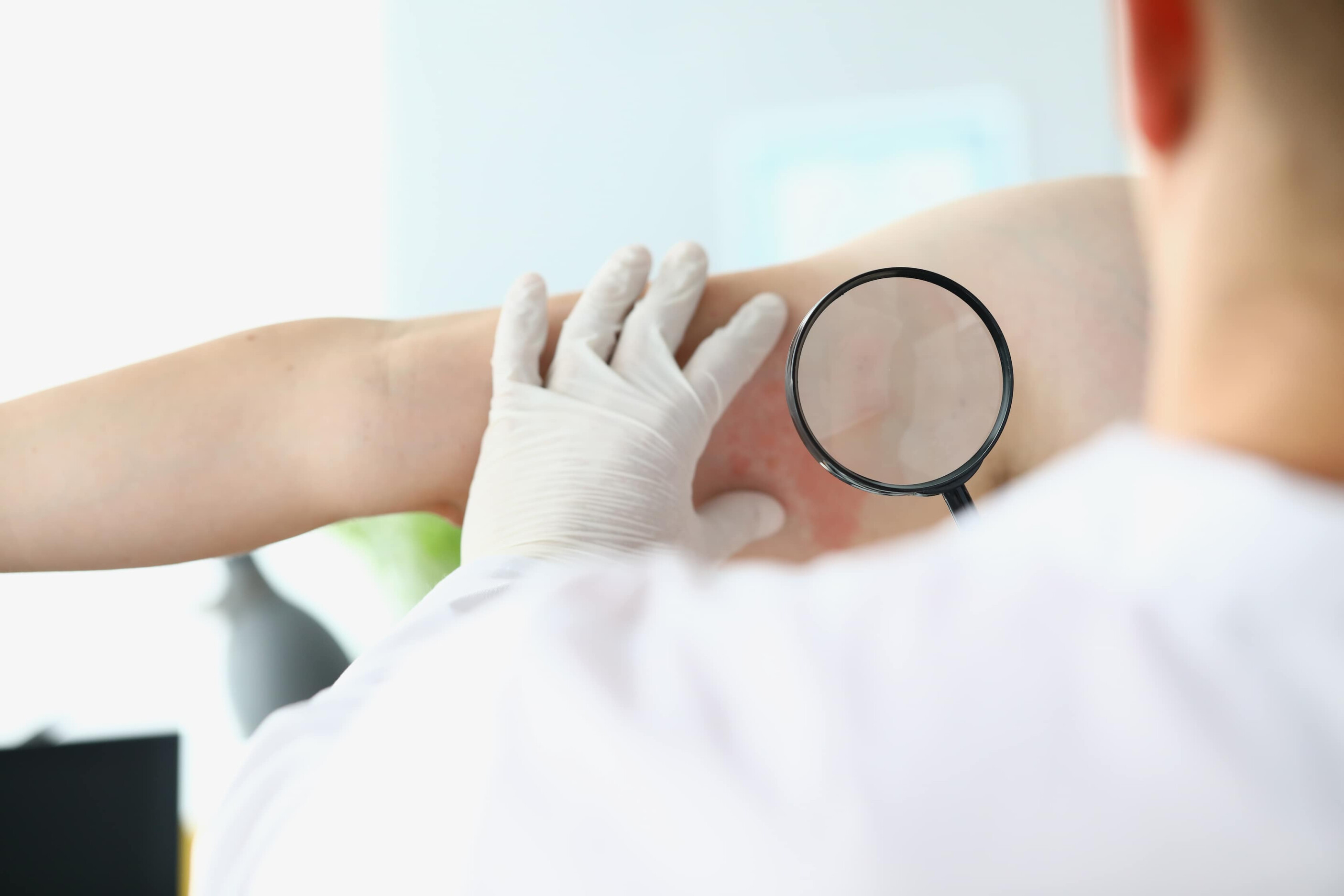 Allergy Skin Test in Turkey | Medical Check Ups in Turkey