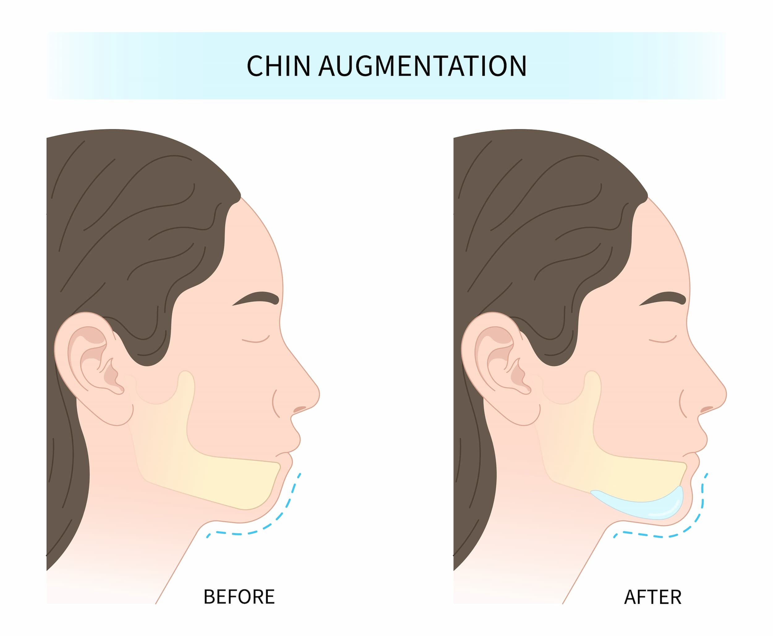 Chin Augmentation in Turkey | Affordable Procedure Prices