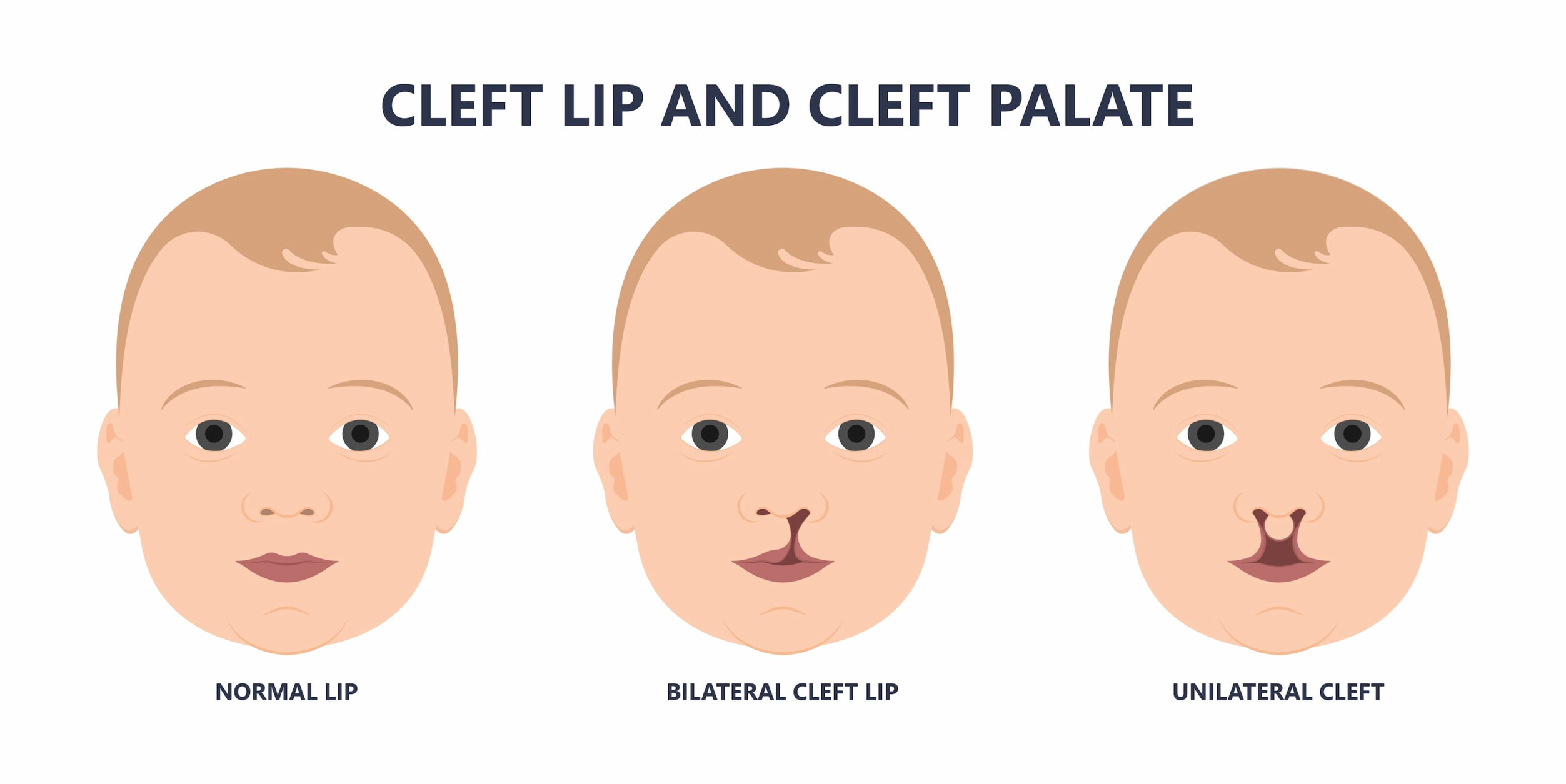 Cleft Lip Repair in Turkey | Check Affordable Prices
