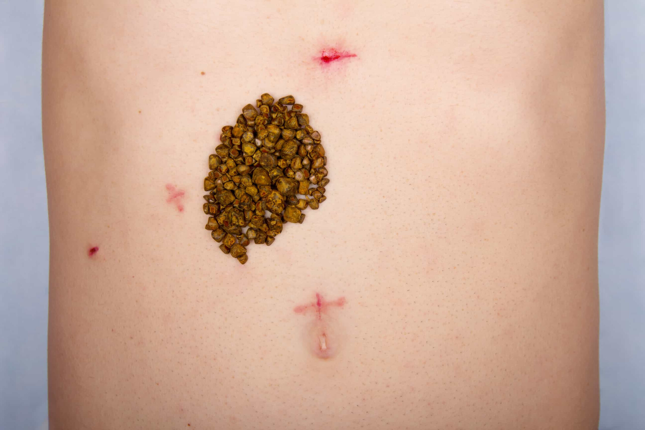 Gallbladder Stone Removal Surgery in Turkey | Cost & Prices