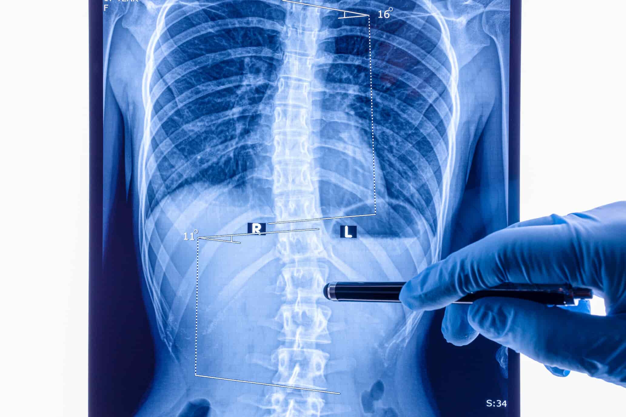 Micro Lumbar Discectomy in Turkey | Check 2026 Cost & Prices