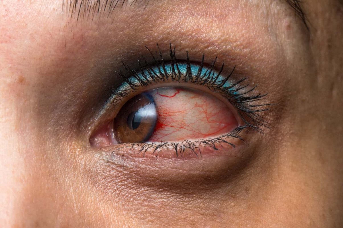Uveitis Treatment in Turkey | Free Online Consultation